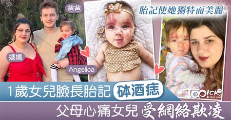 【胎記bb】1歲女童臉長「砵酒痣」被欺凌 父母心痛：胎記使她變得獨特