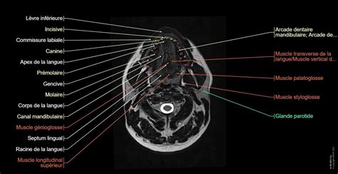Face Et Cou Irm Anatomie Normale E Anatomy