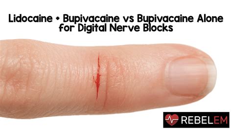Lidocaine Bupivacaine Vs Bupivacaine Alone For Digital Nerve Blocks