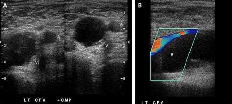 Ultrasound Evaluation Of The Lower Extremity Veins Radiologic Clinics