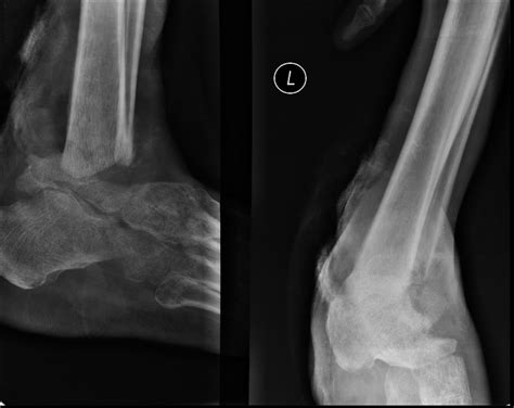 Medical Images Charcots Arthropathy