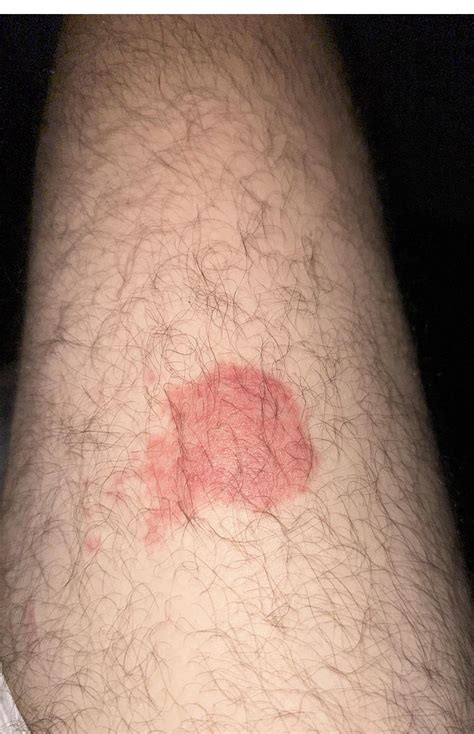 Anyone Bruise After Dupixent Injection R Nasalpolyps