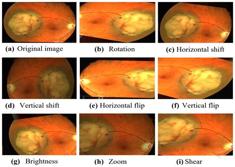 Deep Ocular Tumor Classification Model Using Cuckoo Search Algorithm And Caputo Fractional