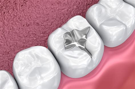 Do You Really Need A Tooth Filling Heres How To Know Blyss Dental