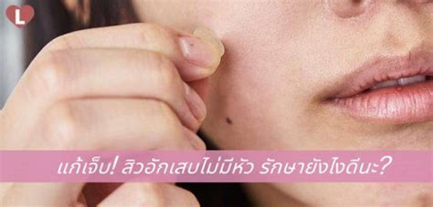 แก้เจ็บ สิวอักเสบไม่มีหัว รักษายังไงดีนะ Ladyissue เว็บรีวิว