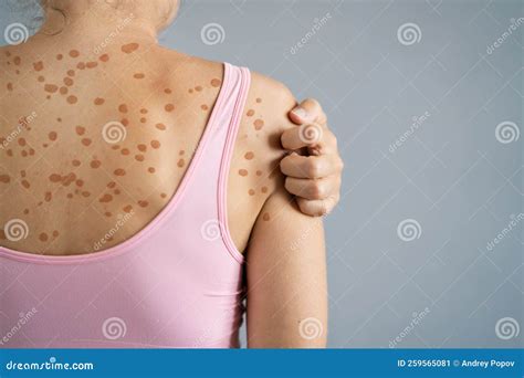 Scratching Itchy Skin Sensitive Eczema Rash Stock Image Image Of