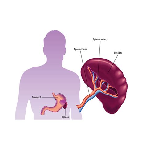 Splenectomy Laparoscopicopen Dr Gerhard Basson