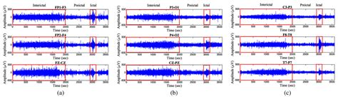Prediction Of Epileptic Seizures Based On Multivariate Multiscale Modified Distribution Entropy