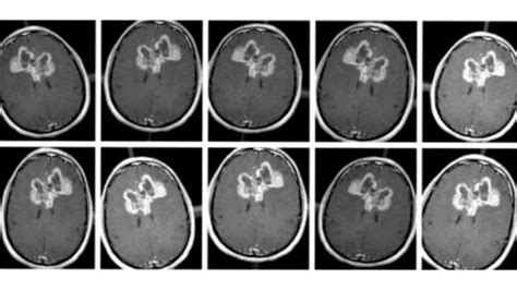 Transfer Learning Brain Tumor Mri Binary Classification Using Deep Learning Models Vgg16 And