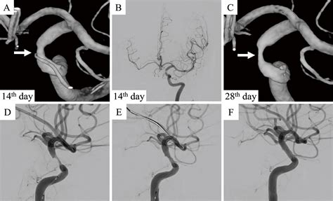Percutaneous Transluminal Angioplasty And Stenting For Progressive Intracranial Carotid Artery