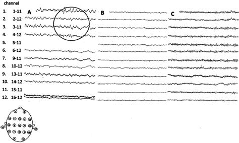 Figure3time Course Of Electroencephalography Eeg Mono Polar 1 Eeg
