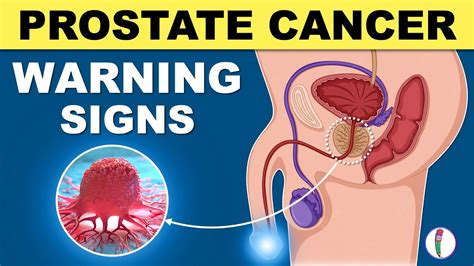 Prostate Cancer Symptoms