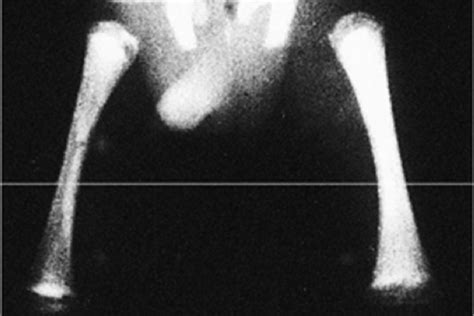 Us Officials Warn Of Dramatic Rise In Infant Syphilis