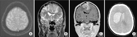 A Gradient Recalled Echo Brain Magnetic Resonance Imaging Mri In