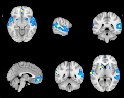 Significant Clusters In Left And Right Superior Temporal Gyrus Download Scientific Diagram