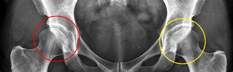 Hip Dysplasia Diagnosis And Treatment Ventura Orthopedics