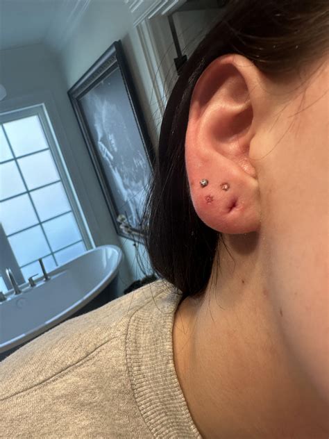 Overnight My Bottom Stack Got Embedded Into My Ear I Can Put Ill