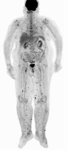 Maximum Intensity Projection Images Show Multiple Nodular Lesions With