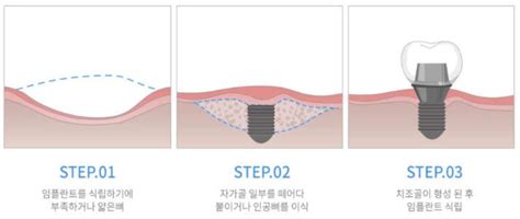 임플란트 뼈이식 비용 최저가 알아보기