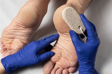 Flaky Skin On The Feet Cracked Heel On Human Foot Dry Flaky Skin
