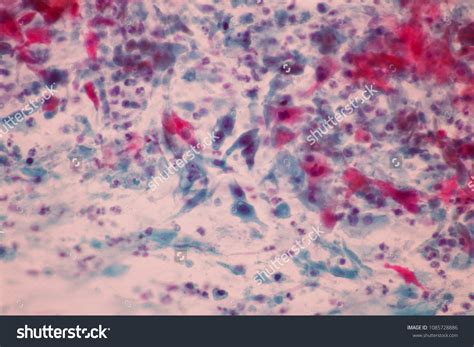Skin Squamous Cell Carcinoma On Genitals Royalty Free Images Stock Photos Pictures Shutterstock