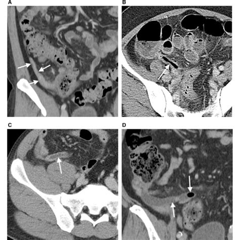 Four Patterns Of Intraluminal Content In Appendicitis Axial And