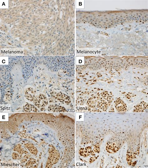 Ab Npm2 Expression Was Evaluated In Melanoma And Normal Melanocytes