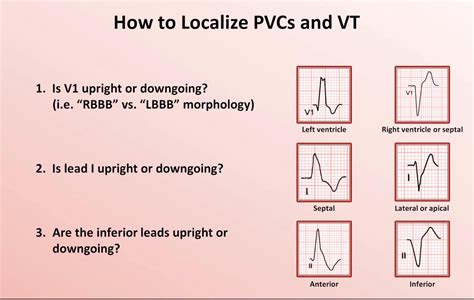 Ecg Challenge The Usefulness Of Pvcs Part 2