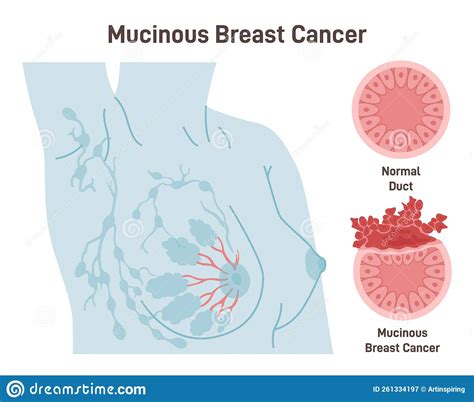Mucinous Breast Cancer Detailed Breast Medical Anatomy With
