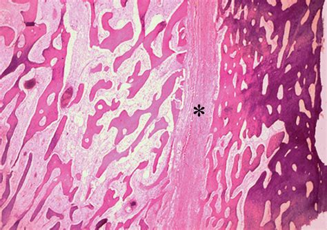 Osteosarcoma Jaw Histology
