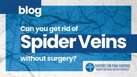 Can You Get Rid Of Spider Veins Without Surgery Maps