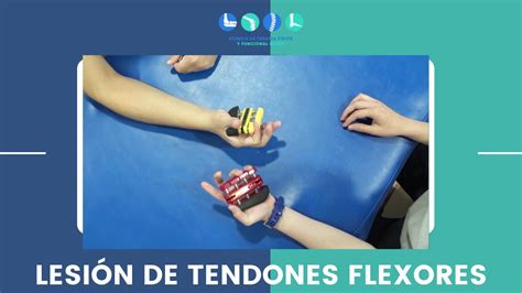Tiempo de Recuperación Tras una Rotura del Tendón en el Dedo de la Mano ...