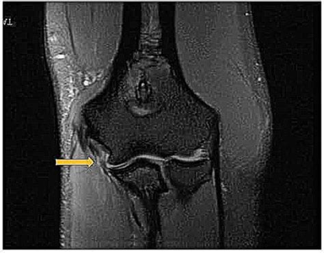 Full Article Evaluation And Management Of Hand Wrist And Elbow