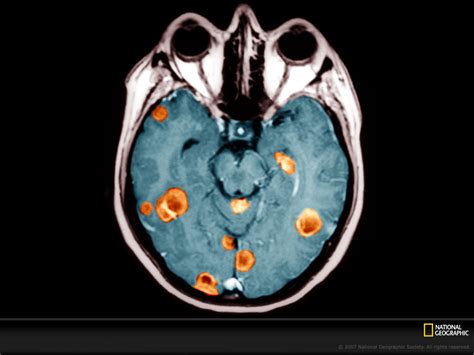 Brain Cancer Ppt Template Ppt Backgrounds Templates