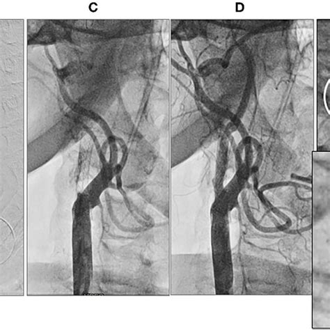 Periprocedural Carotid Artery Stenting Step 1 Baseline Right Internal Download Scientific