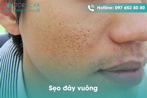 Phương Pháp điều Trị Sẹo Rỗ ở Nam Giới Giải Pháp Lấp đầy Sẹo Nhanh