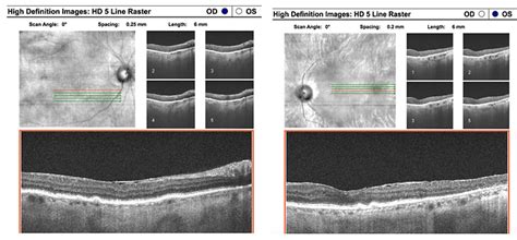 OCTcases Retina Case