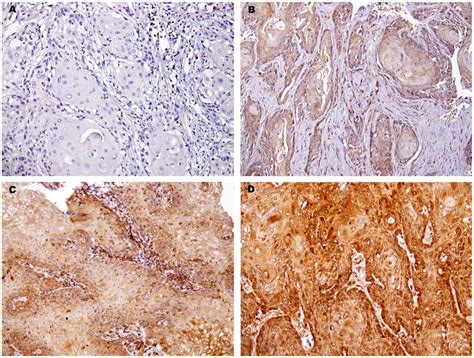 Representative Immunohistochemical Ihc Staining Patterns Of Tumor