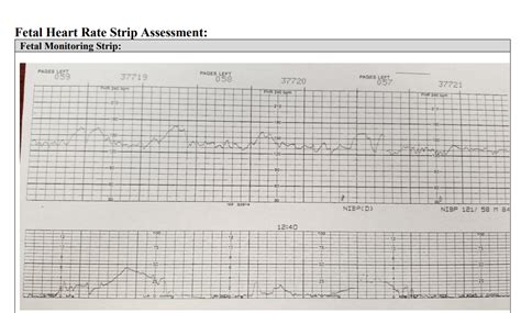 Solved Fetal Heart Rate Strip Assessment What Is The Interpretation
