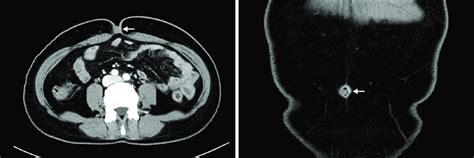 The Computed Tomography Finding Reveals A Small Umbilical Tissular