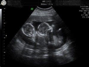 20 Weeks Pregnant With Twins Ultrasound