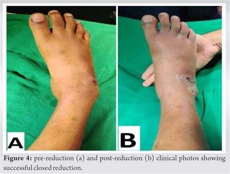 Medial Swivel Dislocation Of The Talonavicular Joint Due To High Energy