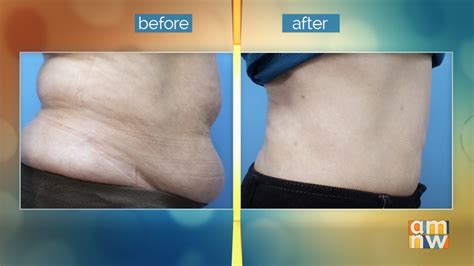 06e97181 5dcc 45b2 B5aa A744ce6b307c Large16x9lipoliftpng