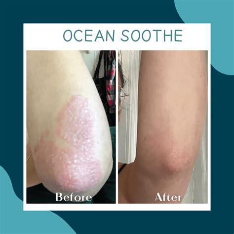Ocean Soothe Psoriasis Lotion 4 Fl Oz