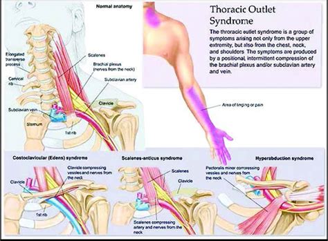 胸廓出口症候群（thoracic Outlet Syndrome） 明醫網