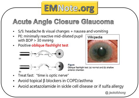 Acute Angle Glaucoma Treatment Prnso