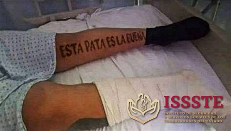 Médicos Del Issste Le Amputan La Pierna Equivocada A Una Paciente En