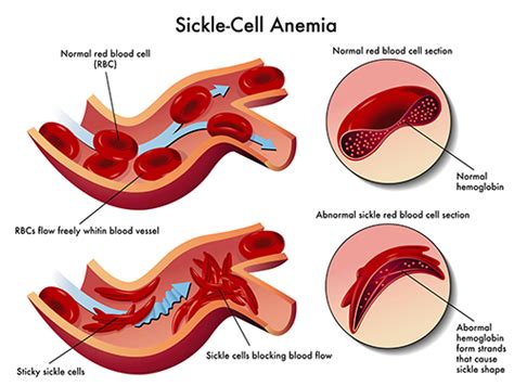 Exciting Advancements Made On Sickle Cell Anemia Cryo Cell
