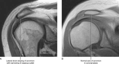 Imaging Of The Shoulder Radiology Key