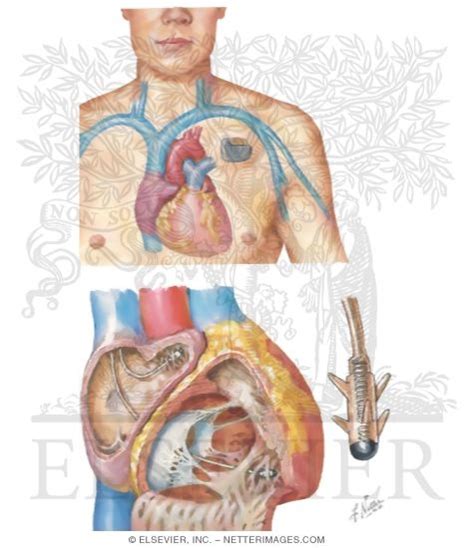 Dual Chamber Cardiac Pacemaker
